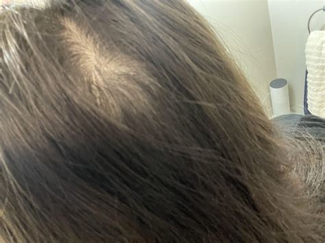 Hair Suddenly Falling Out In Clumps Ive Now Switched Shampoo And