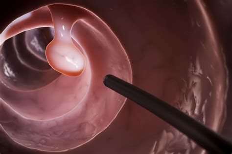 Colonoscopy Examination Of The Colon Au
