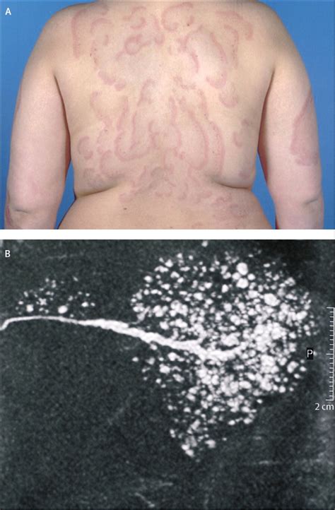 Annular Erythema Of Sjögrens Syndrome The Lancet