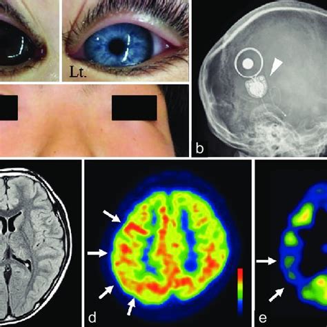Cases Presenting Epilepsy Associated With Waardenburg Syndrome Type I