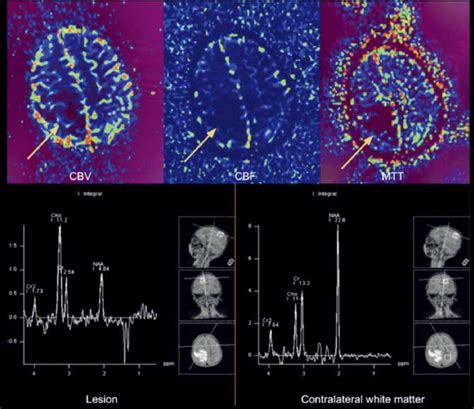 Magnetic Resonance Mr Perfusion Weighted Imaging Top Row