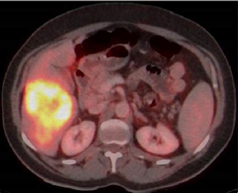Figure 1 From Robotic Assisted Right Hepatectomy Via Anterior Approach