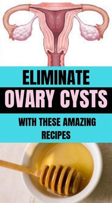 7 Natural Remedies For Ovarian Cysts That Actually Work Artofit