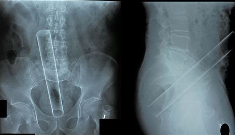x rays of people with objects stuck in them gallery