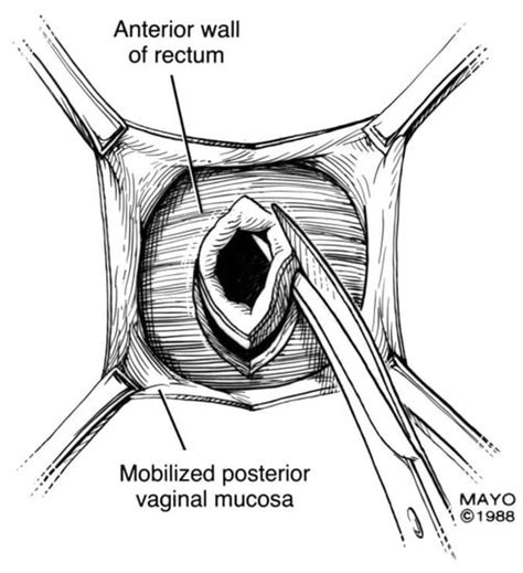 Jcm Free Full Text Colorectal Vaginal Fistulas Imaging And Novel