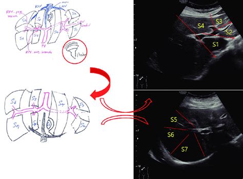 Ultrasonographic Imaging Of The Liver Versus Couinauds Segmental
