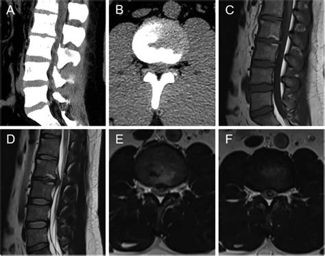 Frontiers Intradural Lumbar Disc Herniation Of L2 L3 A Case Report