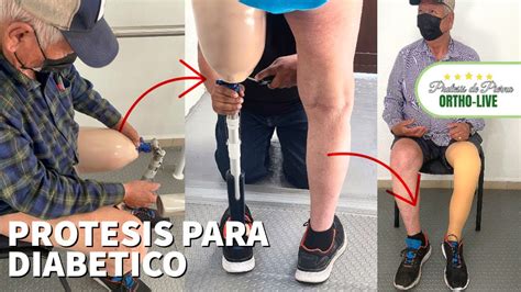 Amputación Por Diabetes Arriba De La Rodilla Prótesis Transfemoral