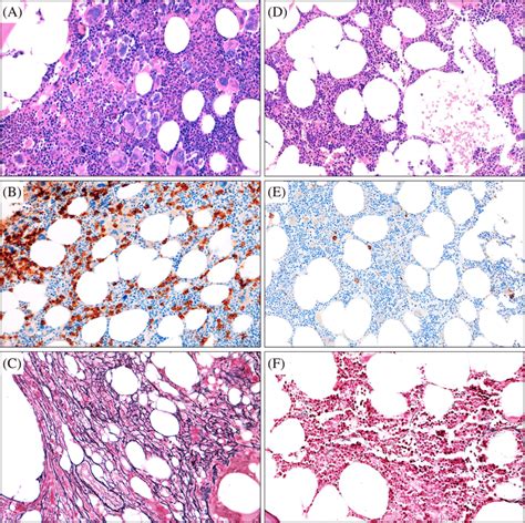Bone Marrow Bm Histopathology Shows A Cellularity Of 80 With