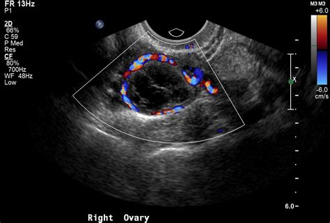 Ultrasound To Differentiate Benign From Malignant Ovarian Tumors—are We