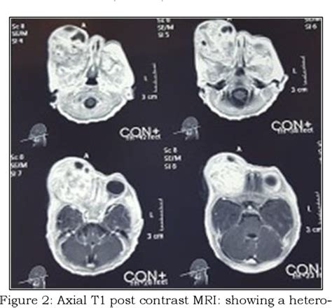 Figure 2 From Congenital Orbital Teratoma A Case Report Semantic Scholar