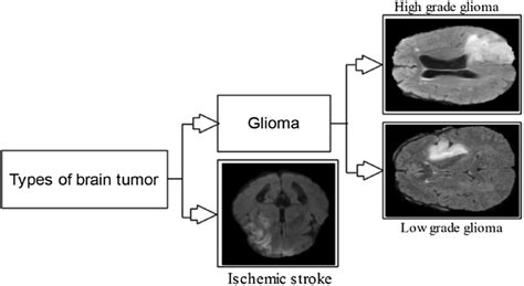 brain tumor types low grade glioma high grade glioma