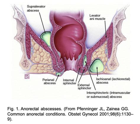 Emergency Medicine Educationanorectal Abscesses Ed