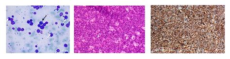 Morphology Of Burkitt Lymphoma Giemsa Stained Fna Smear From An Ebl