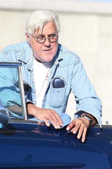 Jay Leno Reveals Face And Hand Scars Seen Driving Cadillac Photos