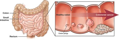 Colorectal Cancer Crc Aga Gi Patient Center