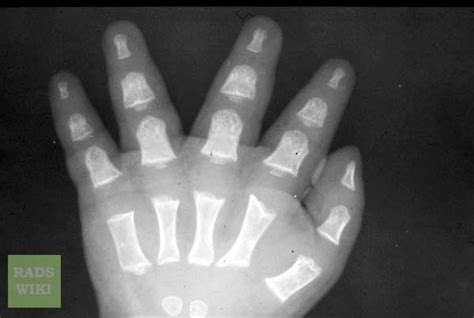ahsmediacenter achondroplasia symptoms and diagnosis 3