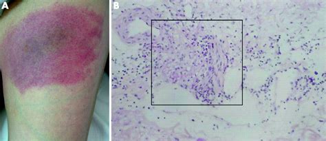 eosinophilic cellulitis wells syndrome as a cutaneous reaction to