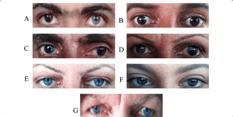 Iris Color Of Waardenburg Syndrome Type 2 Patients A Ii 2 Complete
