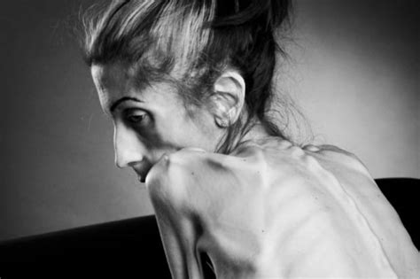 Anorexia En Adolescentes Mortalidad En La Anorexia