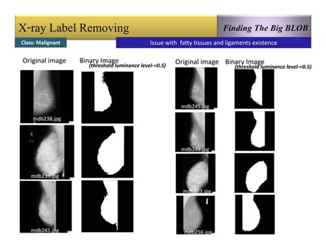 Microcalcification Identification In Digital Mammogram For Early