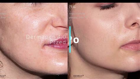 Dermapen 4 0 Zmarszczki Przed I Po Estei Pl Youtube