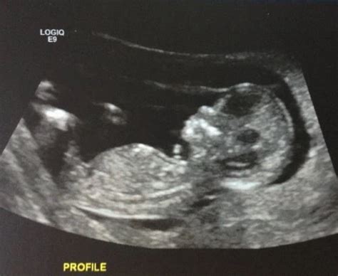 Tests During Pregnancy Trimester Wise Complete Guide [2024]
