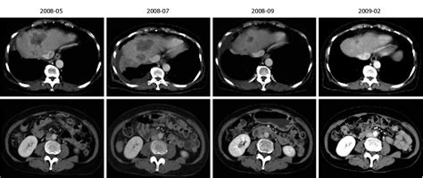 Figure 3 From A Case Of Advanced Intrahepatic Cholangiocarcinoma