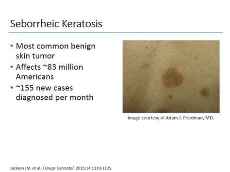 Why Seborrheic Keratosis Should Be On Your Radar Ppt Download