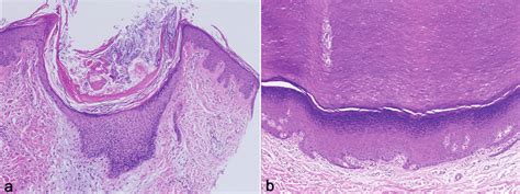 Histopathological Features A Follicular Keratotic Plugging Of A