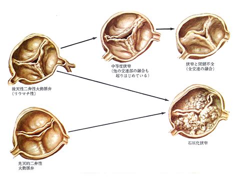 大動脈弁狭窄症とは？原因・症状・治療・手術方法｜循環器内科ニューハート・ワタナベ国際病院