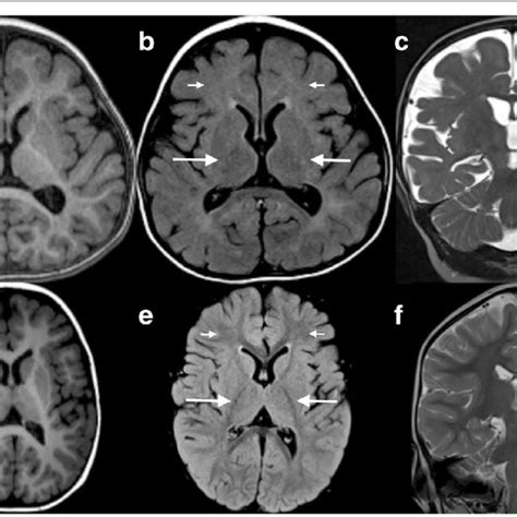 Brain Mri A C Slc35a2 Cdg Patient At 22 Months D F Normal Age And