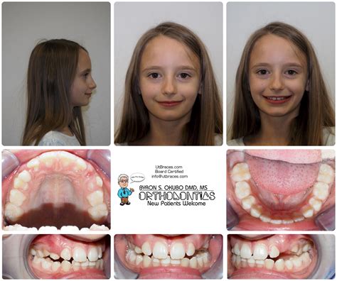 Braces Before And After Overjet