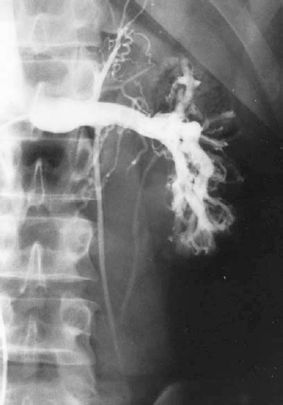 Varicocele And Female Infertility Radiology Key