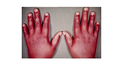 Myxedema What It Is Characteristics And Associated Symptoms