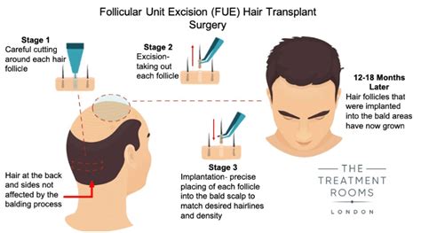 Fue Hair Transplant Treatment Rooms London London Hair Transplants