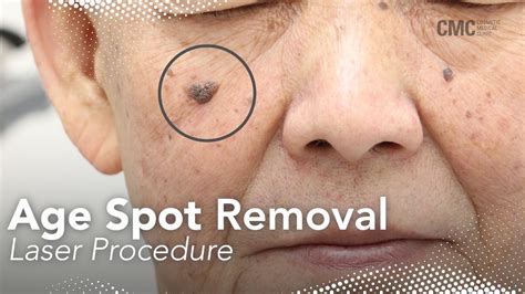 Laser Keratosis Removal Cosmetic Medical Clinic Cmc Nsw Youtube