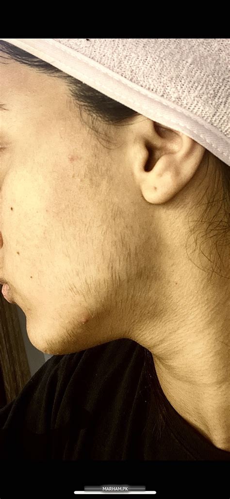 Ask A Dermatologist Online For Hirsutism Facial Hair