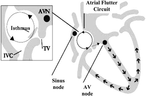 atrial flutter circulation