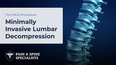 Minimally Invasive Lumbar Decompression Mild Procedure Youtube