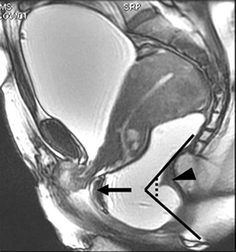 Dynamic Mr Imaging Of The Pelvic Floor A Pictorial Review Radiographics
