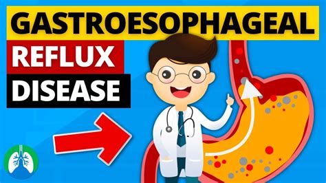 Gastroesophageal Reflux Disease Gerd Explained