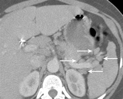 Mesenteric Lymph Nodes Seen At Imaging Causes And Significance