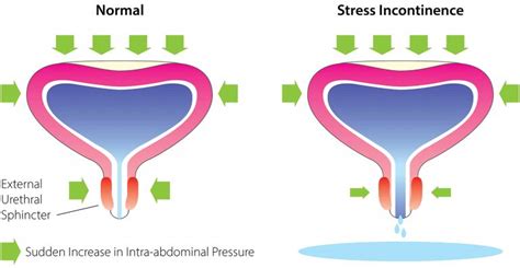 Stress Urinary Incontinence Diagram Insync Marrickville Physiotherapy
