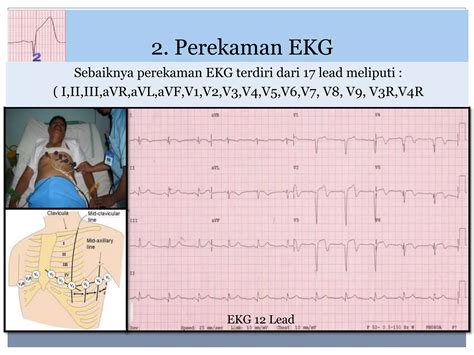 Sindrom Koroner Akut Ppt