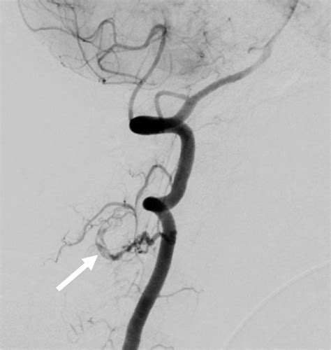 Endovascular Treatment Was Performed With N Butyl Cyanoacrylate