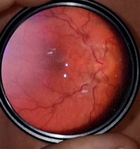 Hypotony Maculopathy Retina Image Bank