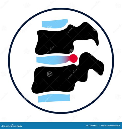 Intervertebral Hernia Concept Stock Vector Illustration Of Herniated