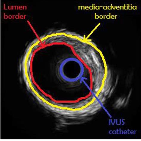 A Typical Ivus Image Download Scientific Diagram