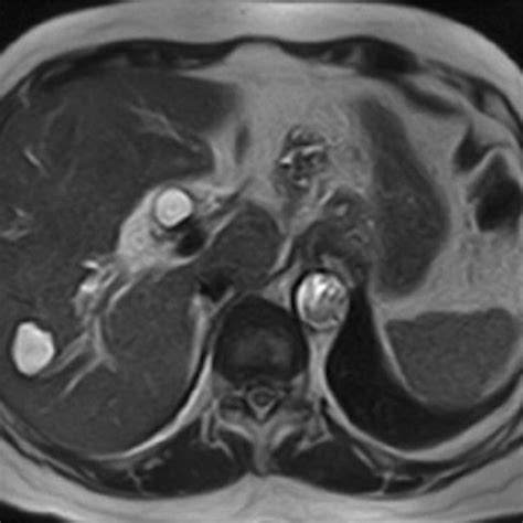 Magnetic Resonance Imaging Mri Of The Abdomen Showing Biliary Duct